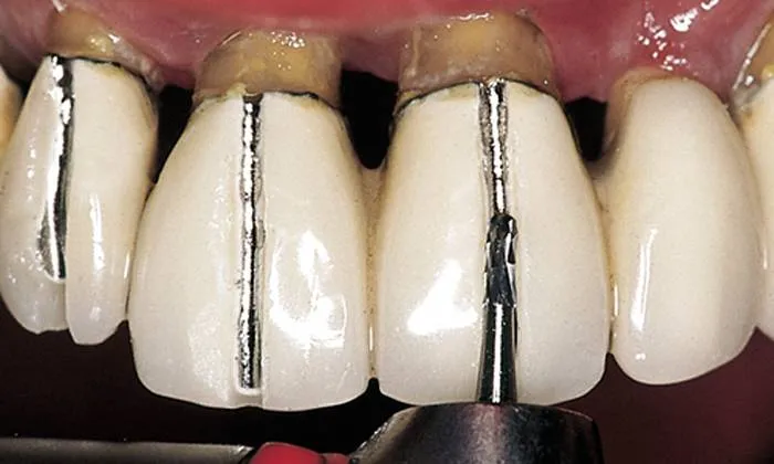 Metal Ceramic Crown Preparation, Diamond/Carbide Bur - Syndent